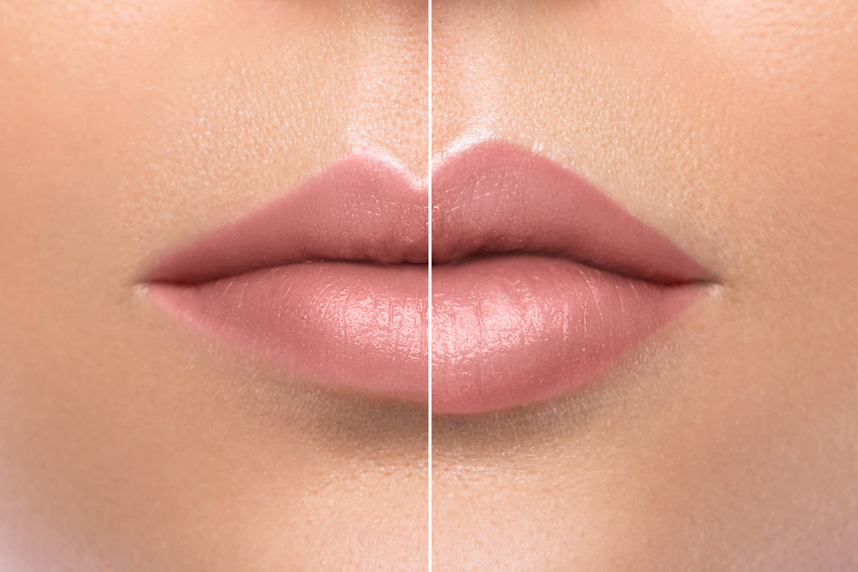 Comparison of female lips after augmentation - Dr. Niketa Sonavane