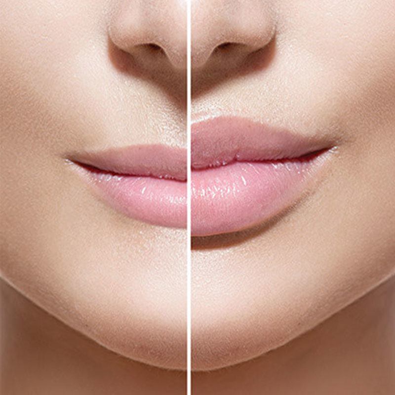 Comparison of female lips after augmentation - Dr. Niketa Sonavane