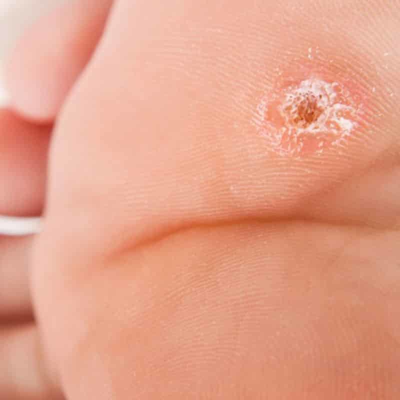 corns - Dr. Niketa Sonavane