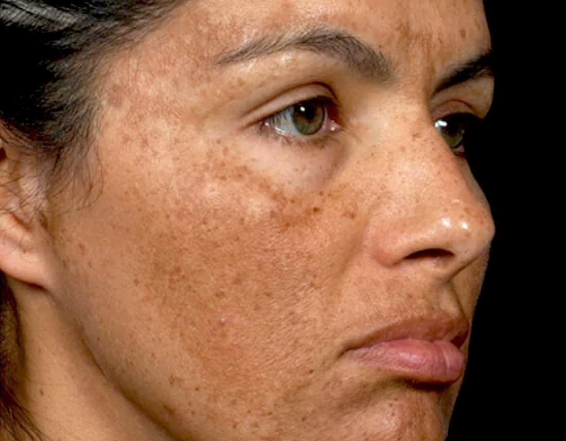 Pigmentation Treatment in Mumbai, Melasma treatment in Mumbai