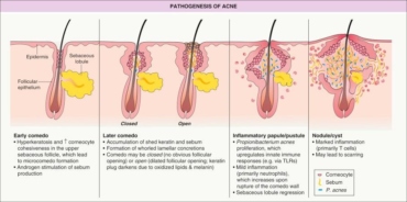 Causes of Acne - Dr. Niketa Sonavane