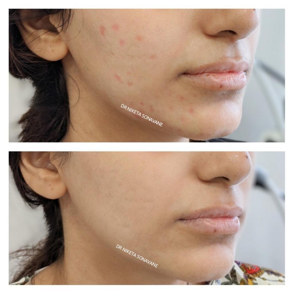 Acne Scar Treatment in Mumbai – Cost, Before After Results, Laser