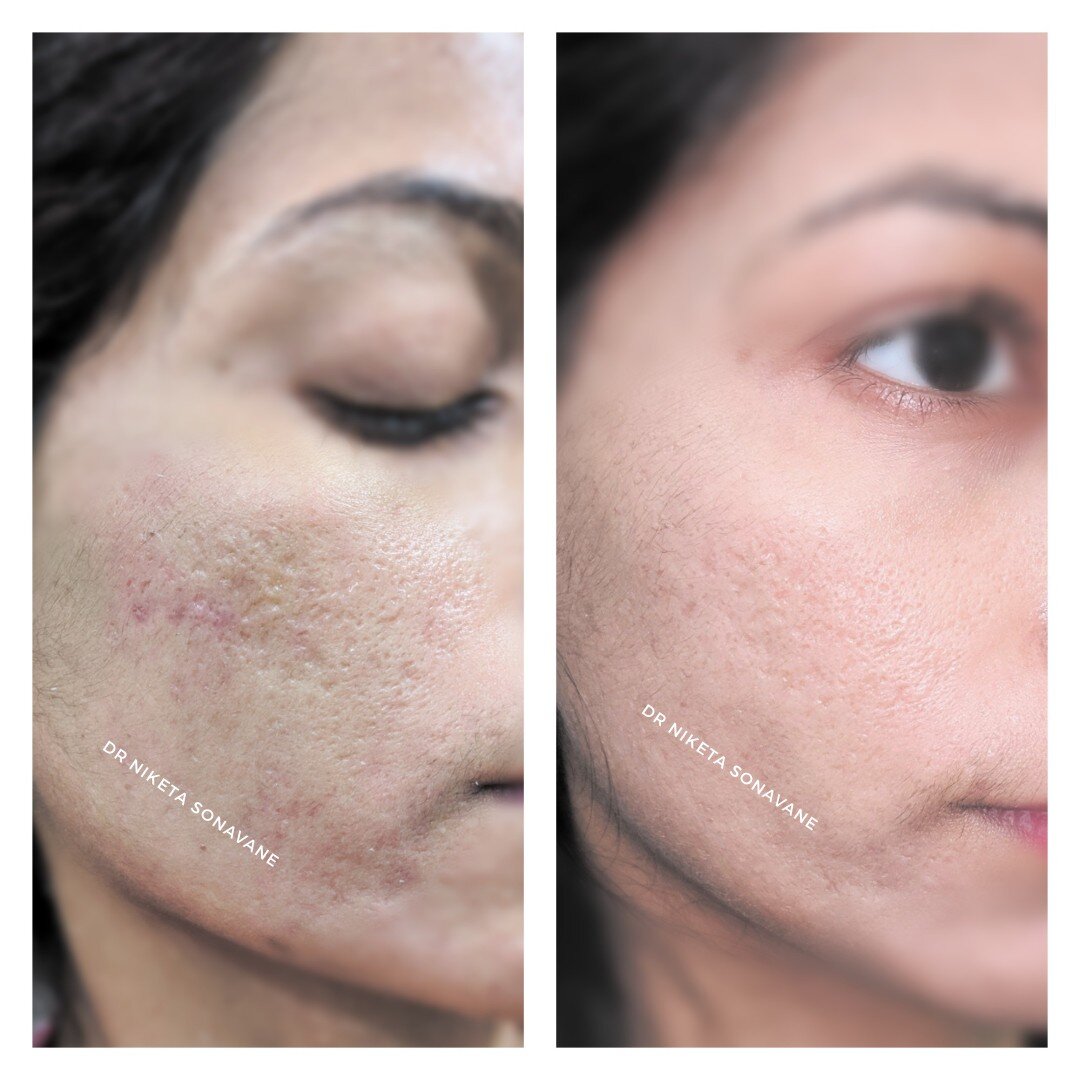 Prp Skin Treatment In Mumbai Prp Treatment Cost Procedure My XXX Hot Girl