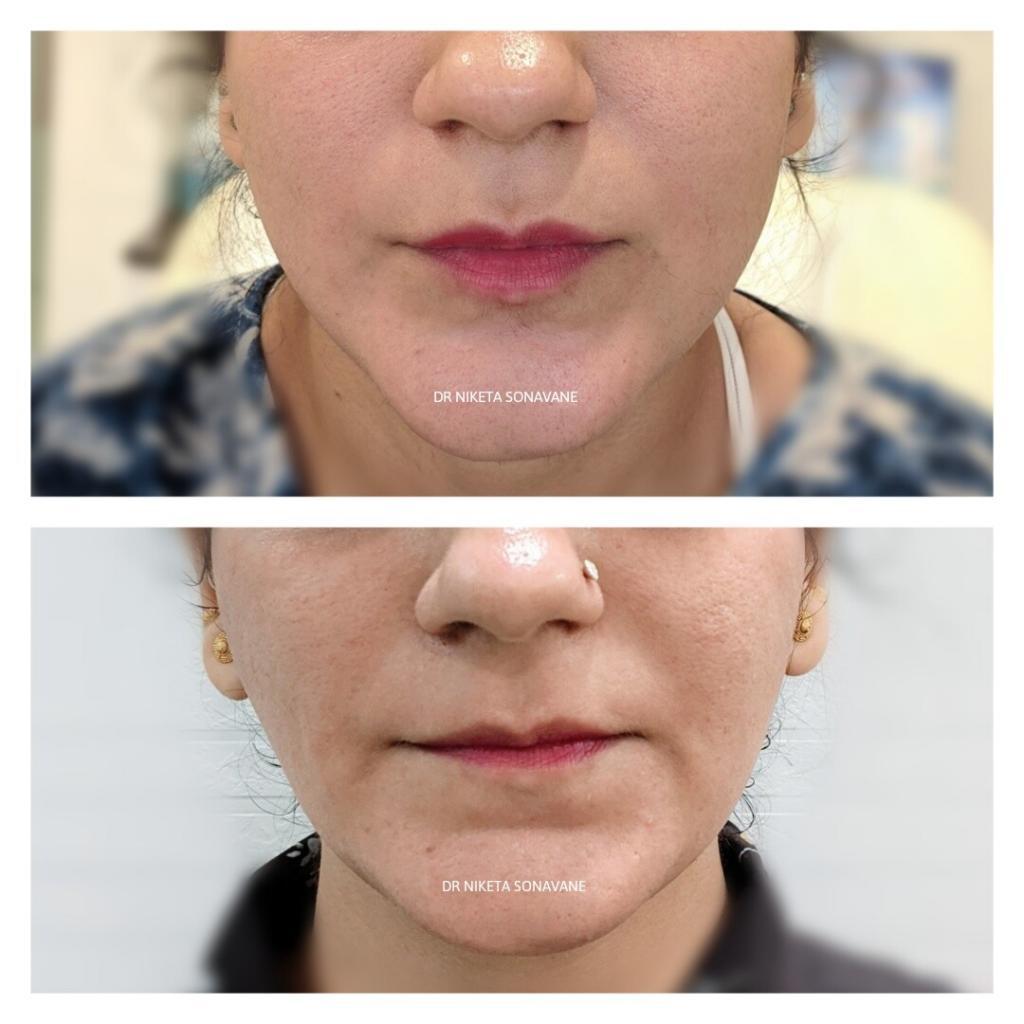 Dermatologist in Mumbai, Skin Treatment Before and After Photos