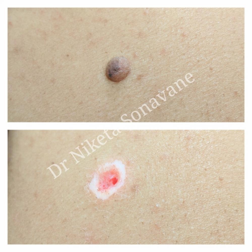 Milia, Molluscum, Mole Removal Mumbai - Laser, Cautery, Surgery