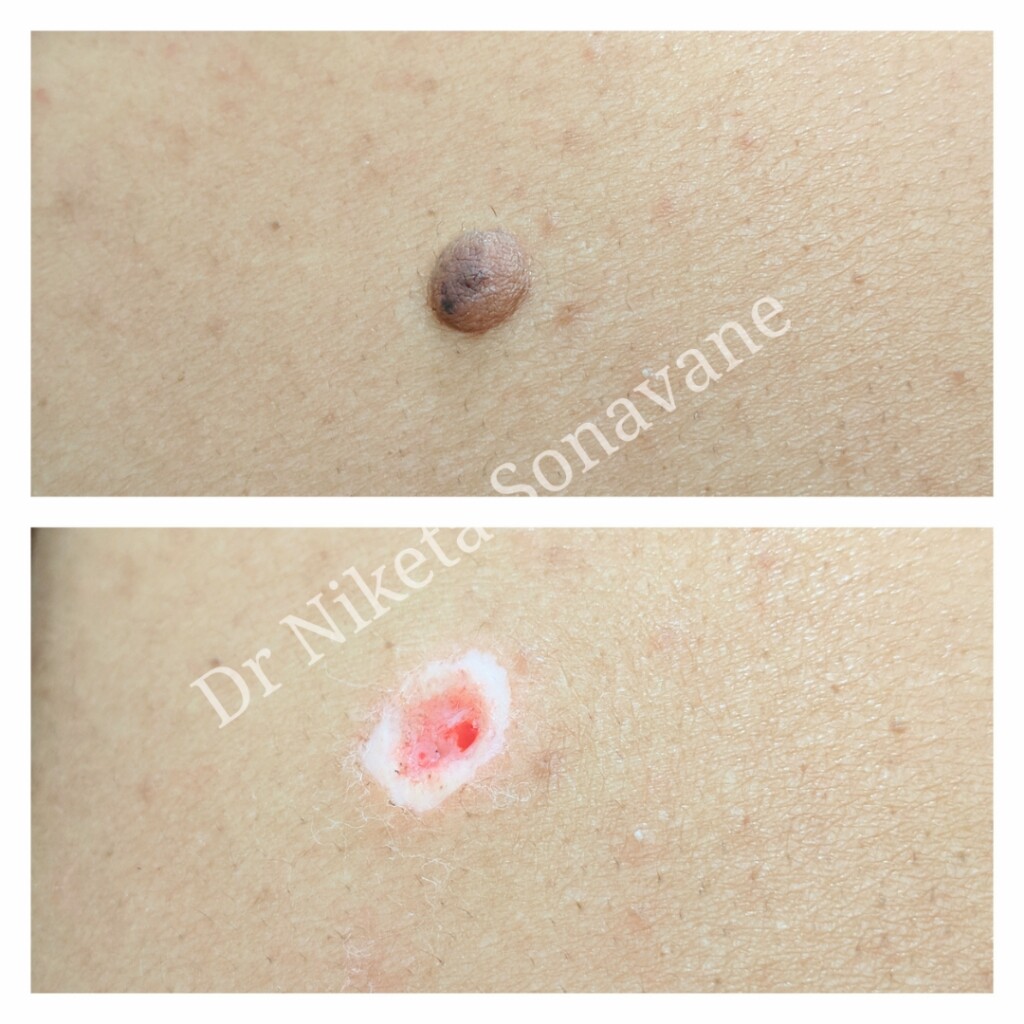 Milia, Molluscum, Mole Removal Mumbai - Laser, Cautery, Surgery