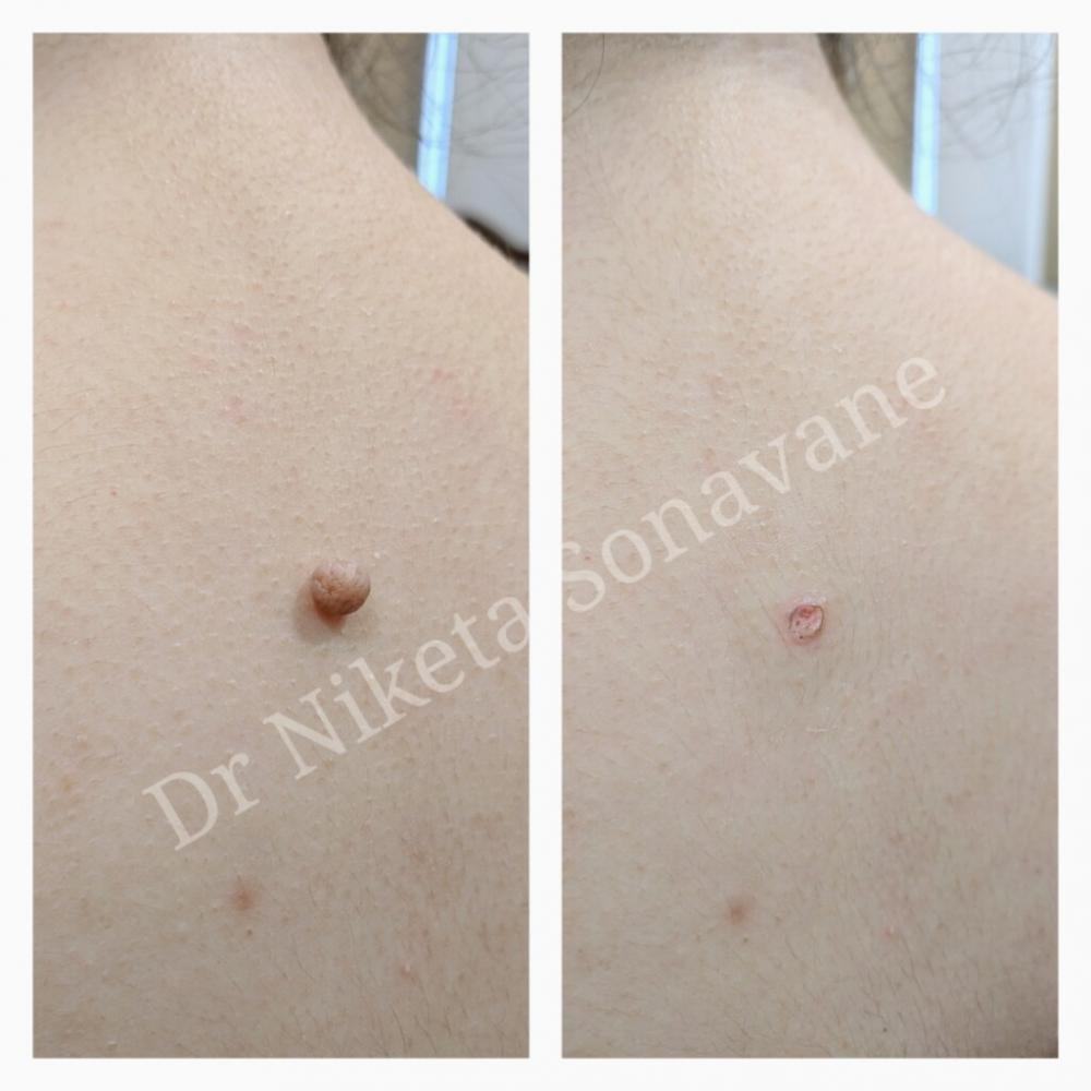 Milia, Molluscum, Mole Removal Mumbai - Laser, Cautery, Surgery