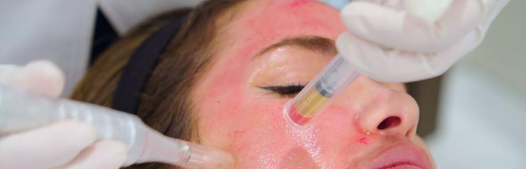 PRP Skin Treatment in Mumbai, PRP Treatment in Mumbai - Cost